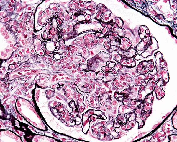 移植腎病理研究会